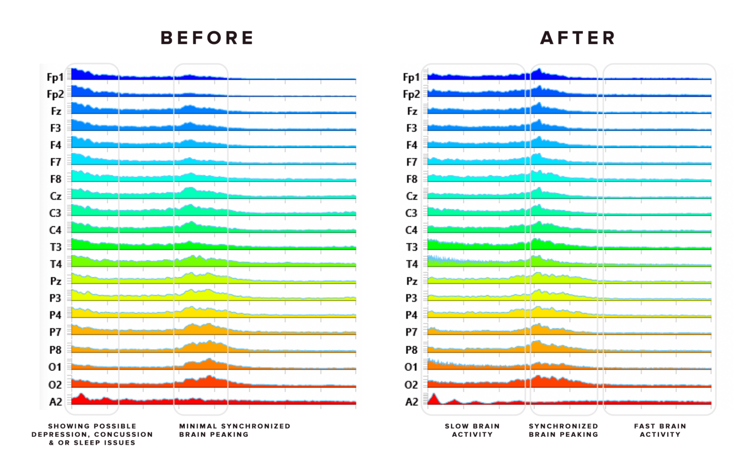 Understanding TMS with Brain Scan Technology