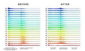 Understanding TMS with Brain Scan Technology